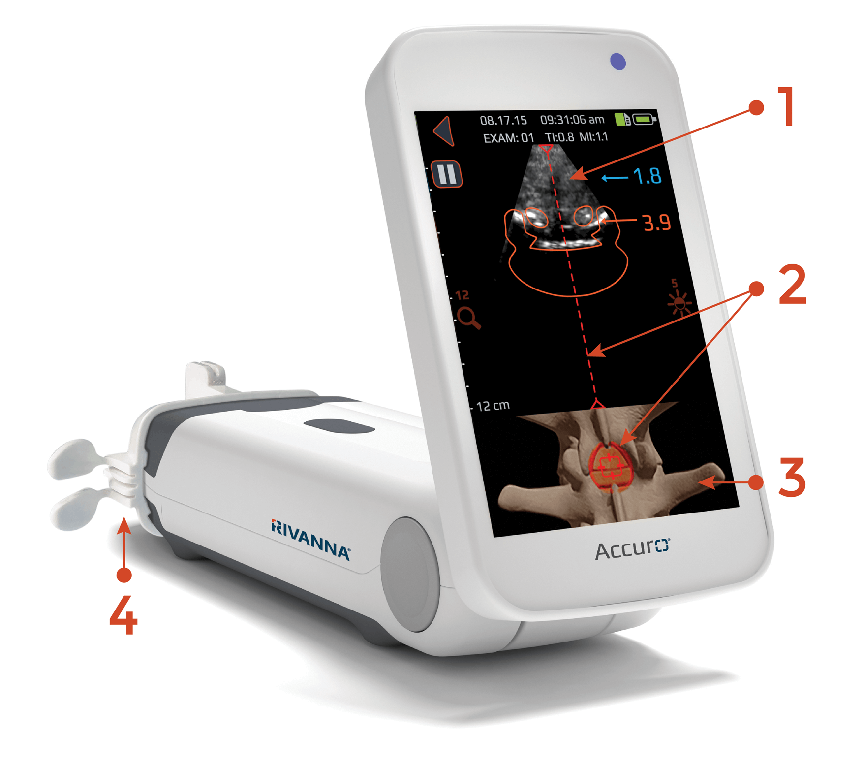 Ultrasound Made Simple with Accuro Neuraxial Guidance